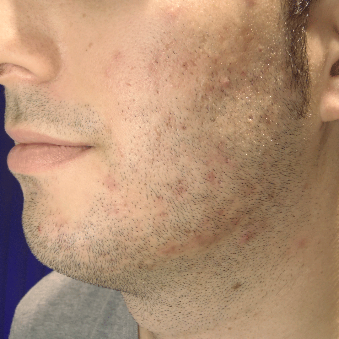 Eliminación De Secuelas De Acné Imebelle Clínica Estética